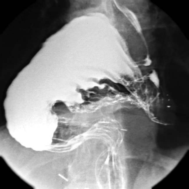 Gastric Volvulus | Radiology Key