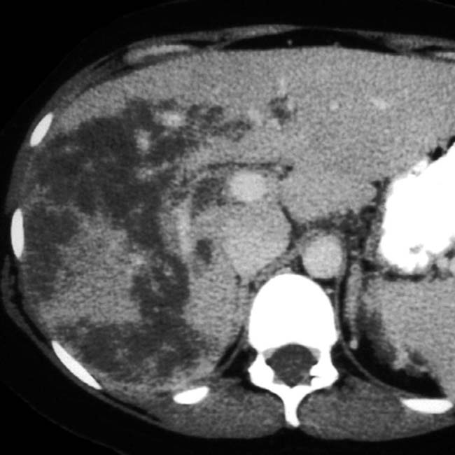 HELLP Syndrome | Radiology Key