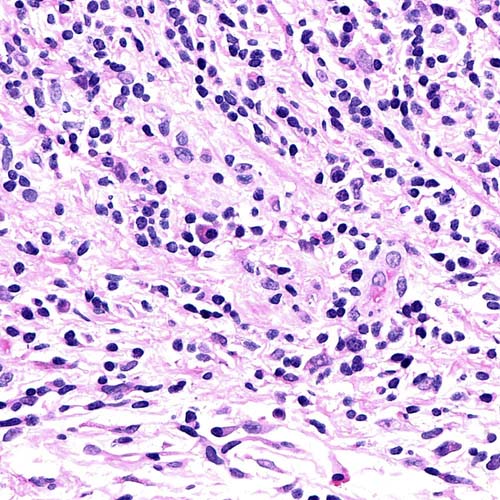 Autoimmune (IgG4) Cholangitis | Radiology Key