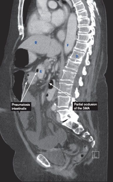 Small Bowel | Radiology Key