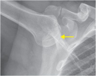 77 48-year-old male complains of shoulder pain and limited range of ...