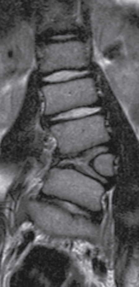 Congenital Disorders of the Spine and Spinal Cord | Radiology Key