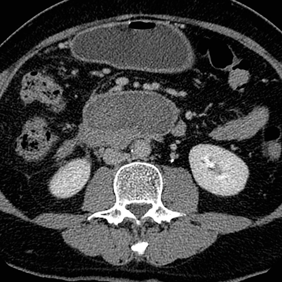 Stomach | Radiology Key