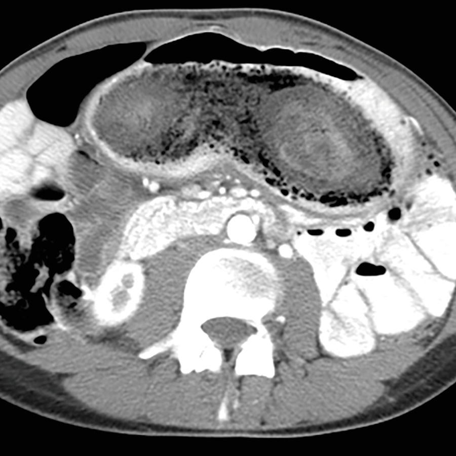 Stomach | Radiology Key