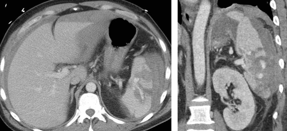 Spleen | Radiology Key