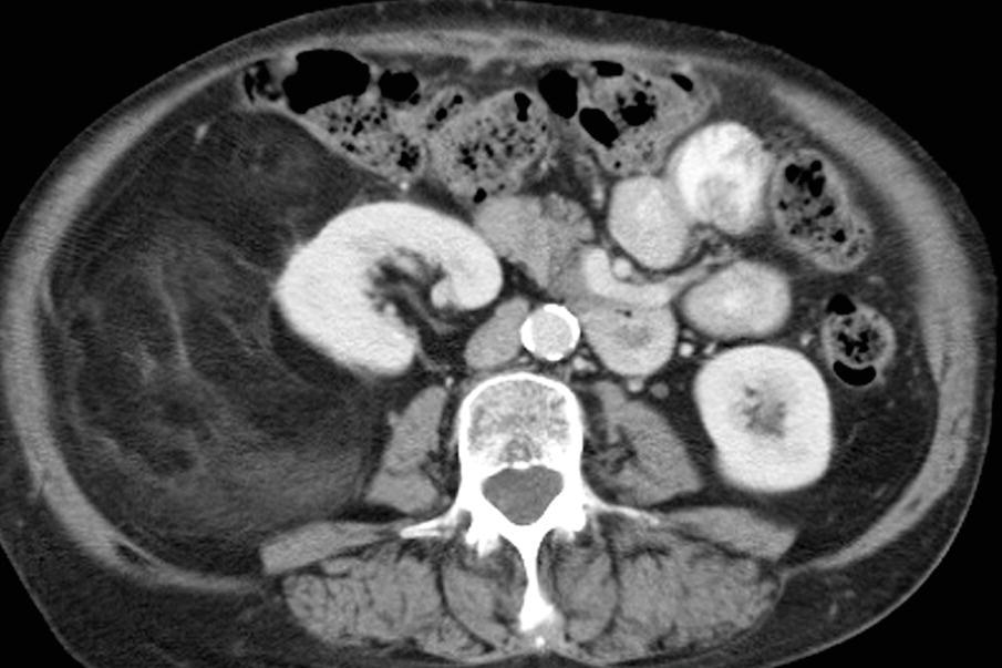 Peritoneum and Retroperitoneum | Radiology Key