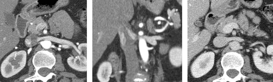 Peritoneum and Retroperitoneum | Radiology Key