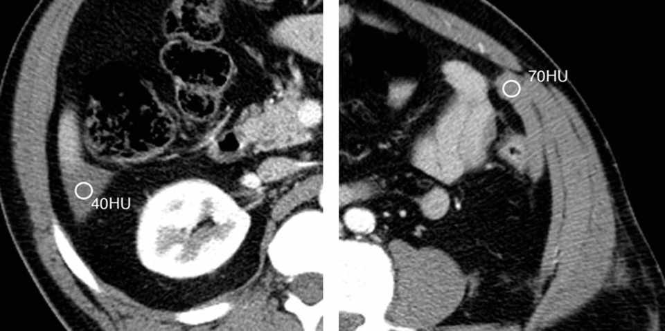 Peritoneum and Retroperitoneum | Radiology Key