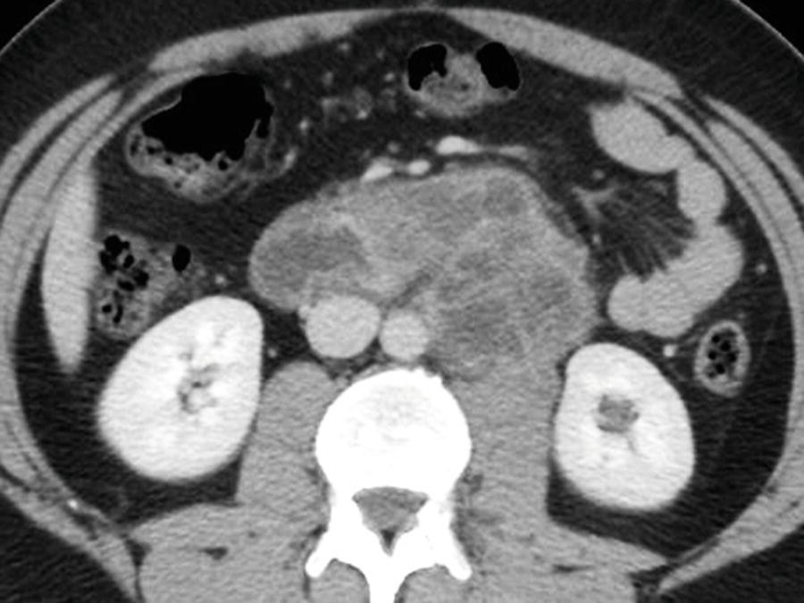 Peritoneum and Retroperitoneum | Radiology Key