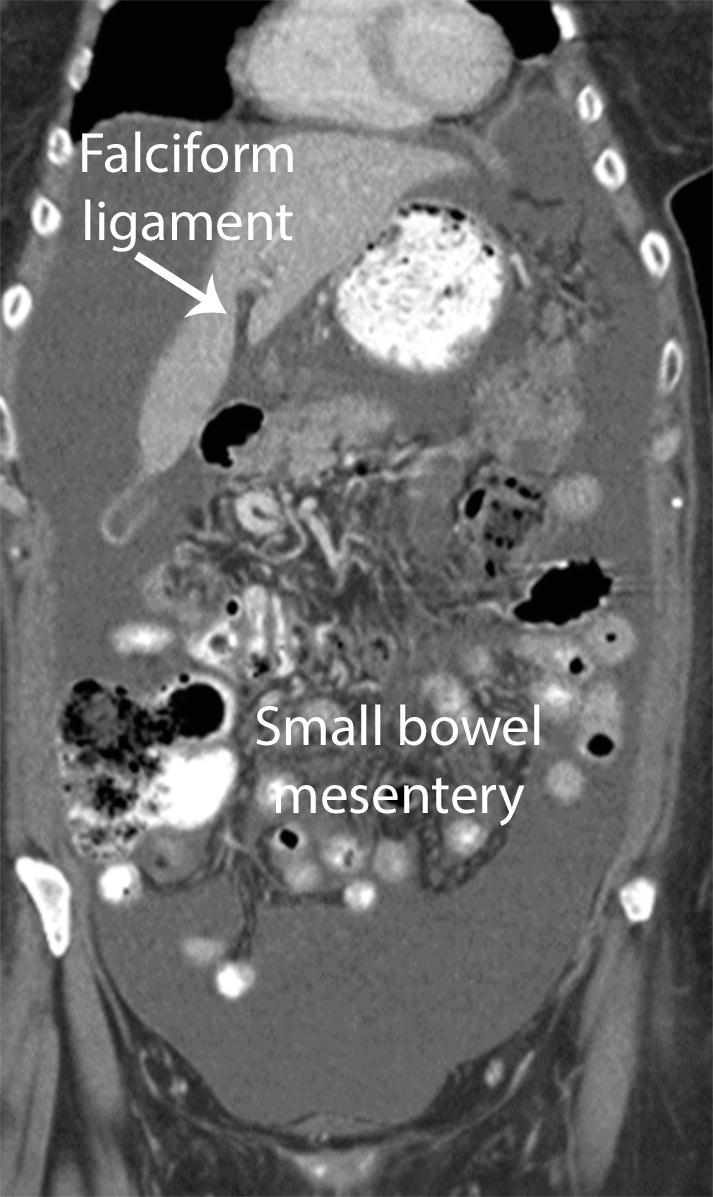 Peritoneum and Retroperitoneum | Radiology Key