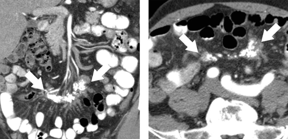 Peritoneum and Retroperitoneum | Radiology Key