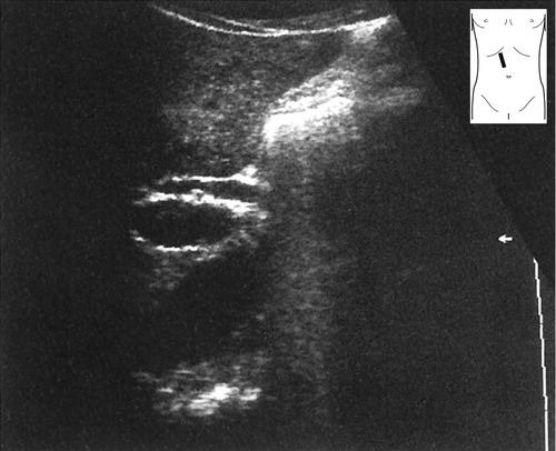 Gallbladder and Biliary Tract Scanning Protocol | Radiology Key