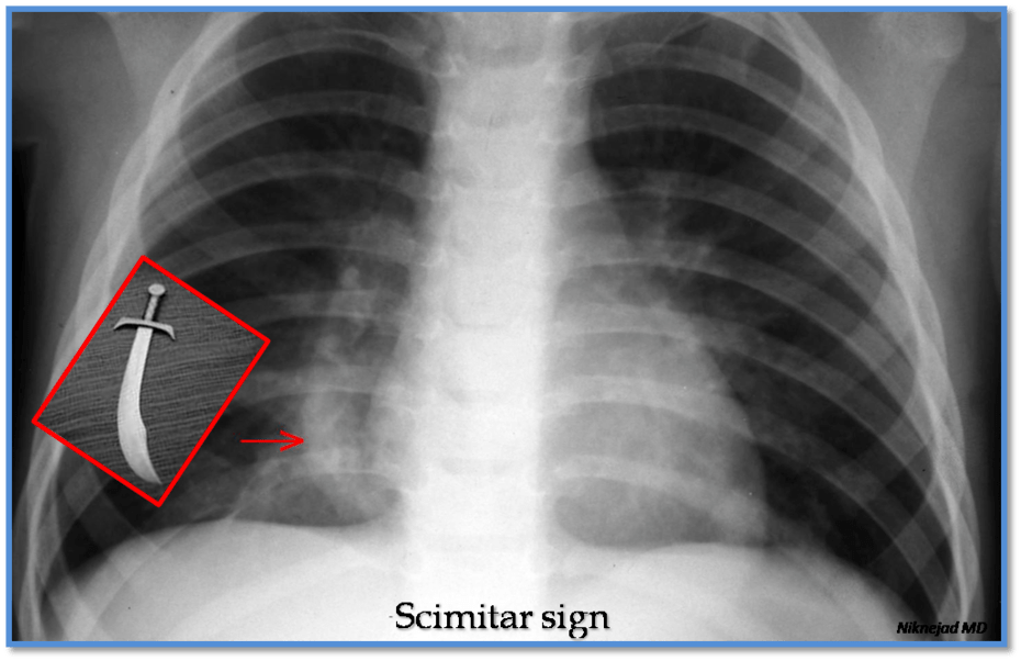 Scimitar sign - radRounds Radiology Network