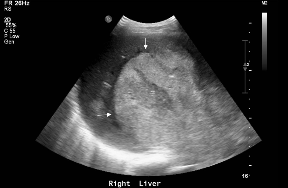Large Hepatocellular Carcinoma on Ultrasound - radRounds Radiology Network