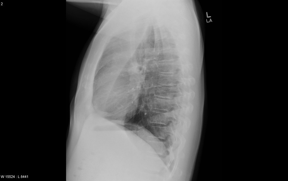 Left upper lobe collapse - as seen on lateral CXR - radRounds Radiology ...