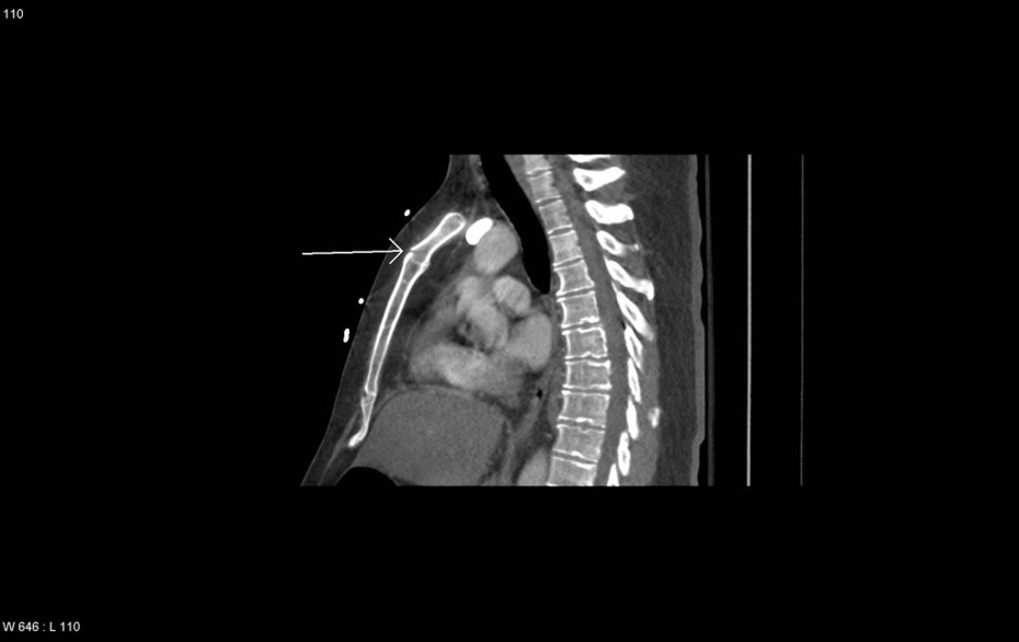 Fracture of Manubrium - radRounds Radiology Network