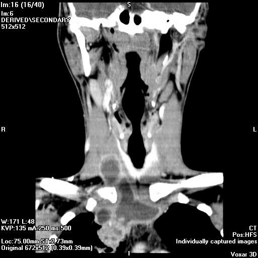 Scrofula: The Reactivation - radRounds Radiology Network