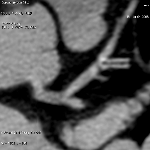 Diagonal coronary artery stent occlusion on CT - radRounds Radiology ...