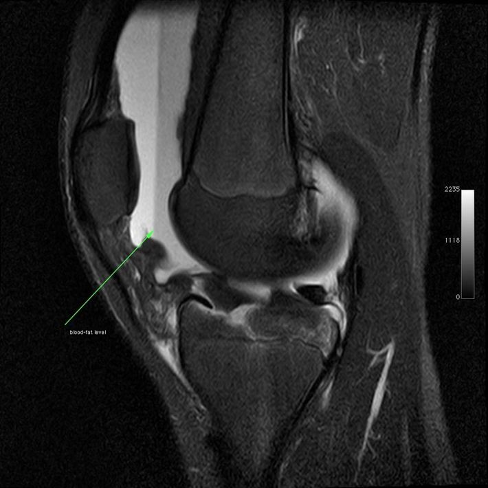 Lipohemarthrosis on MRI - radRounds Radiology Network