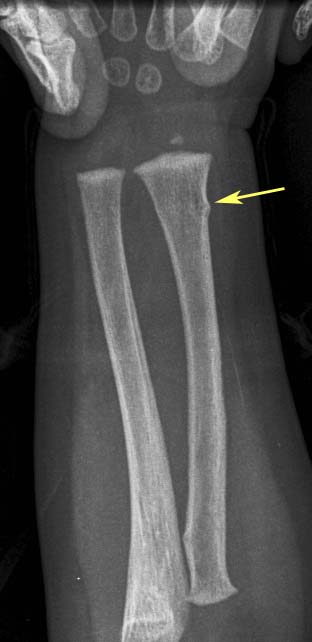 Torus (Buckle) Fracture - radRounds Radiology Network