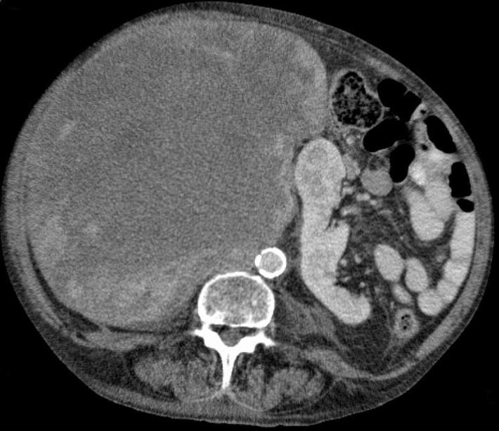 Retroperitoneal Liposarcoma - radRounds Radiology Network