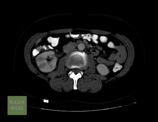 Acute pyelonephritis (CT) - radRounds Radiology Network