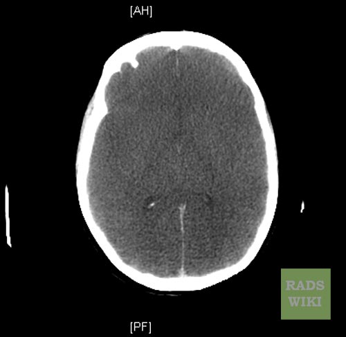 Anoxic brain injury (CT Head) - radRounds Radiology Network