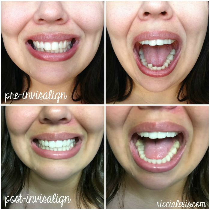 Review Of How To Make Your Own Invisalign References - How To