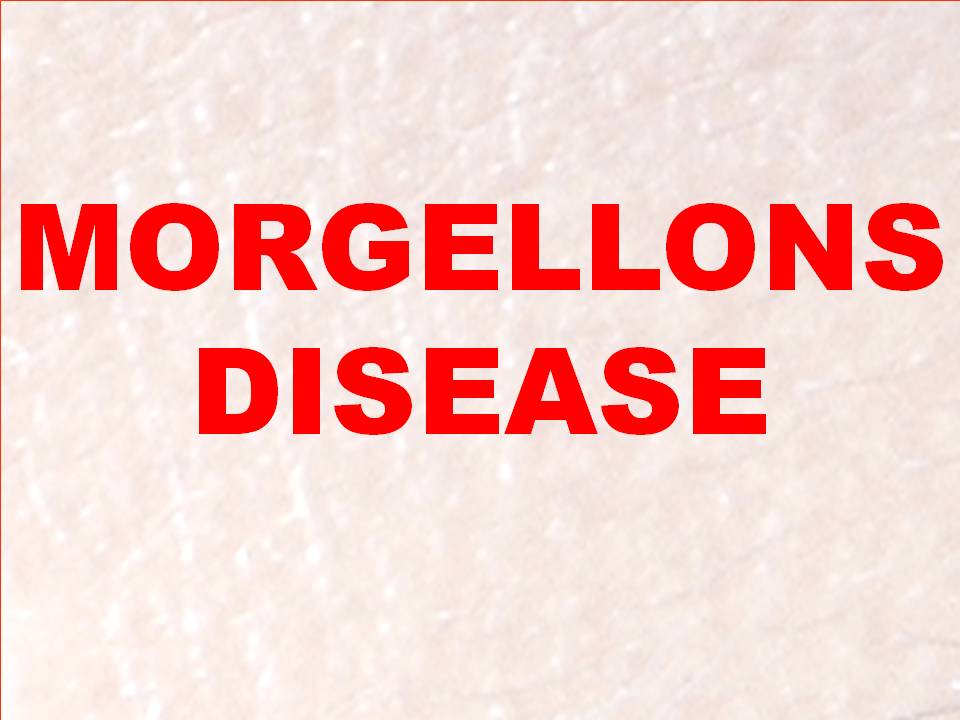 Ask a Dermatologist Online: Morgellons Disease - Skin Specialists Online