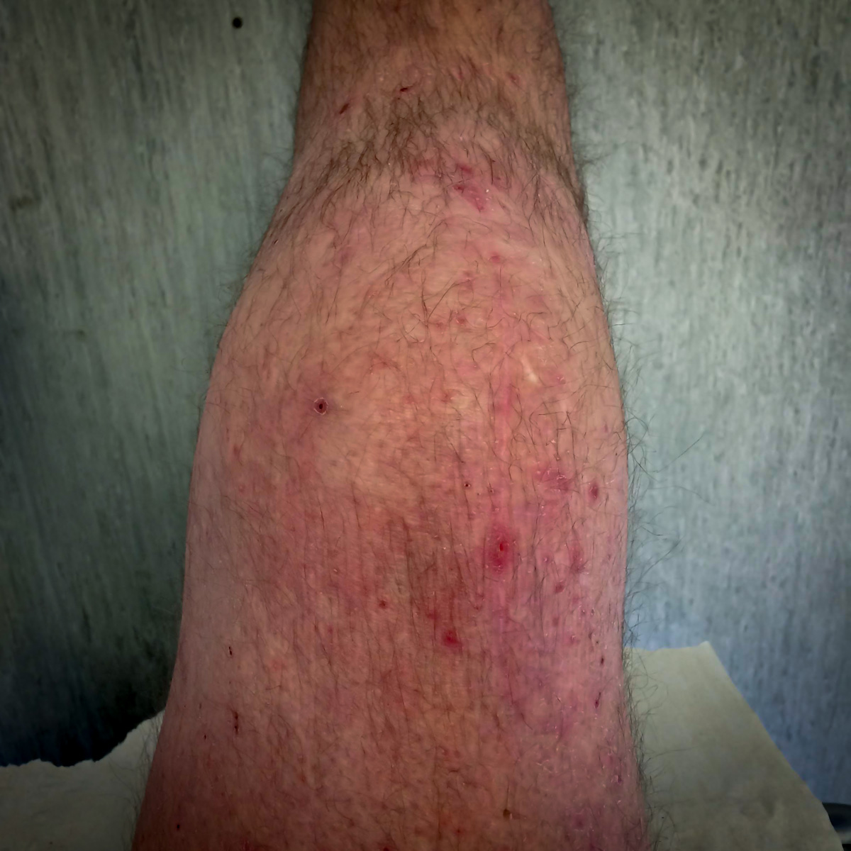Quadriceps Tendon Rupture Recovery Phase 5 Swedanes dk quadriceps-tendon-rupture-recovery-phase-5-swedanes-dk