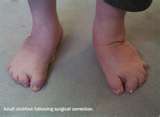 Orthotics For Flat Feet (Pes Valgo Planus) - Theta Orthotics