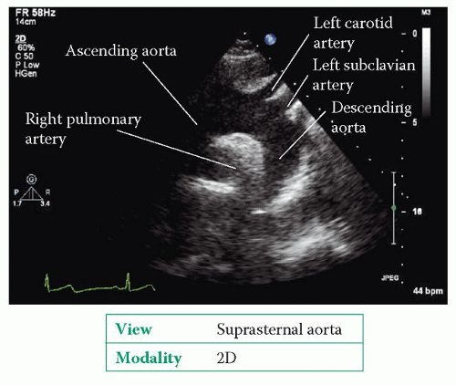 The Standard Transthoracic Echo Study | Thoracic Key
