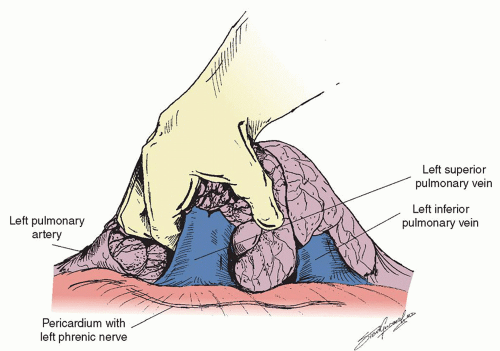 Pneumonectomy | Thoracic Key