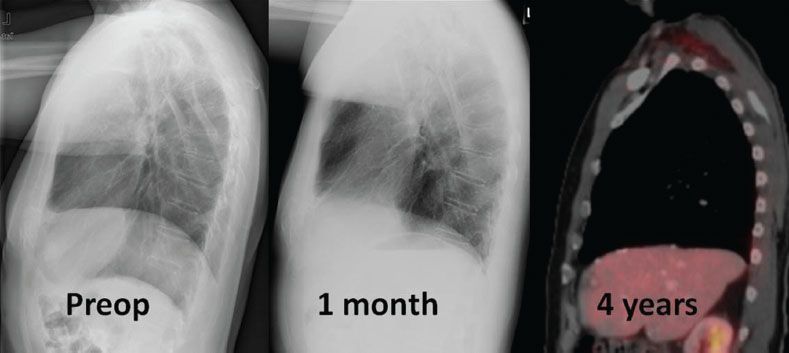 Laparoscopic Diaphragmatic Plication | Thoracic Key