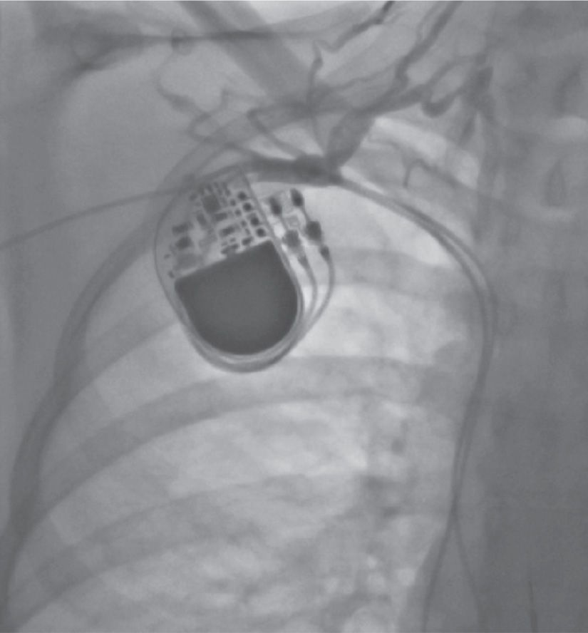 Right Heart Catheterization Using the Arm: Total Wrist Approach for ...