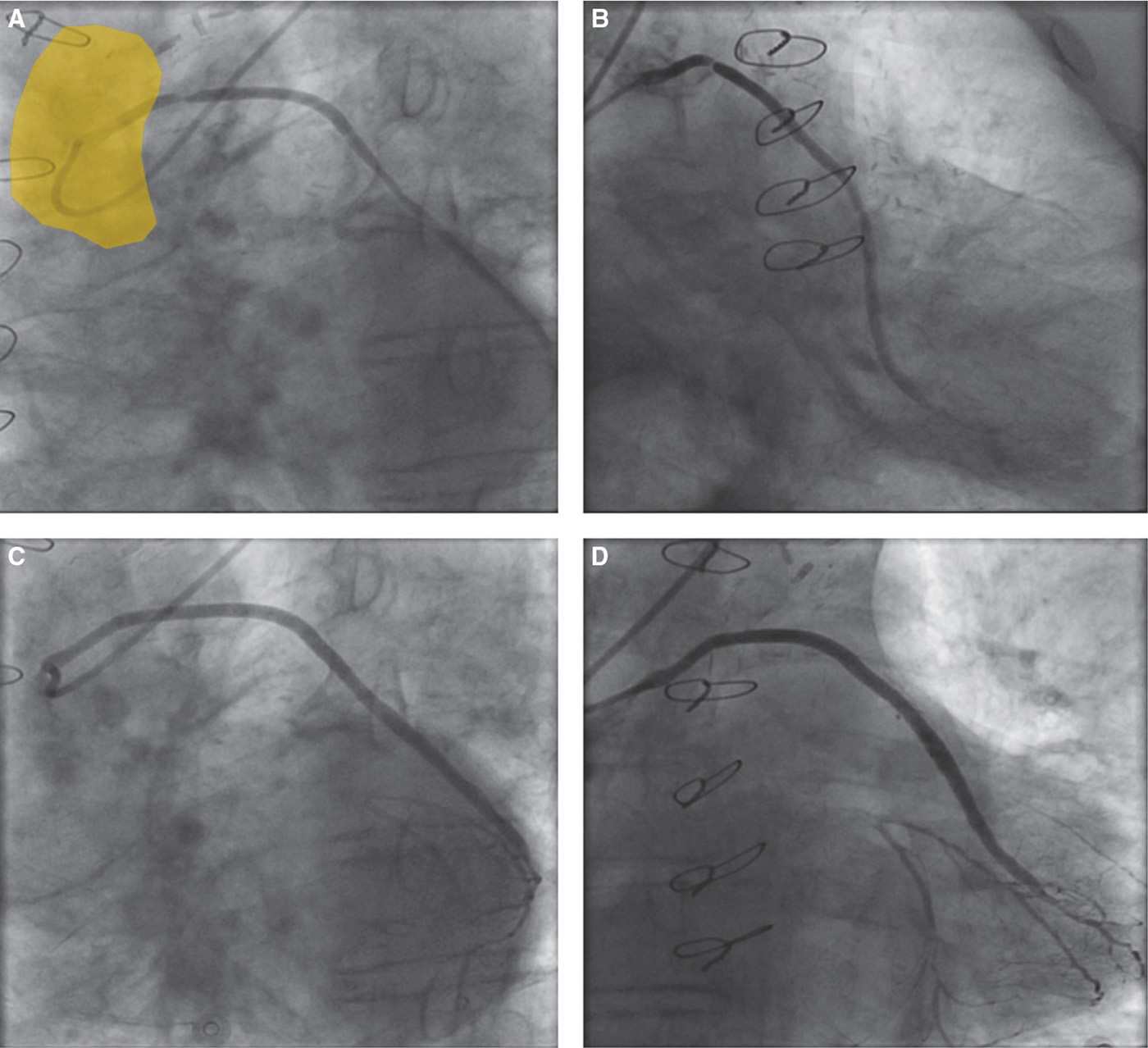 Transradial Approach for Diagnostic and Interventional Procedures in ...