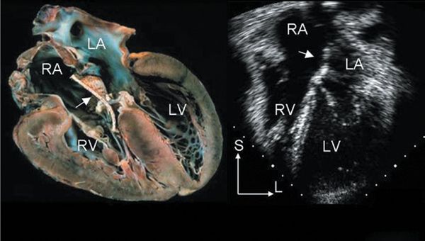 Atrioventricular Septal Defects | Thoracic Key