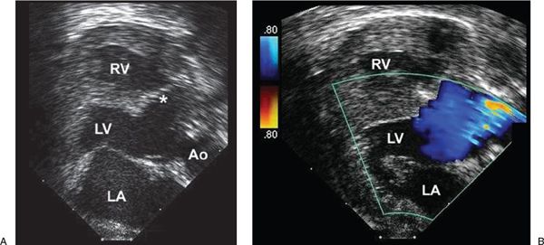 Intracardiac and Intraoperative Transesophageal Echocardiography ...