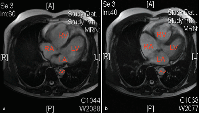Sinoatrial Exit Block | Thoracic Key