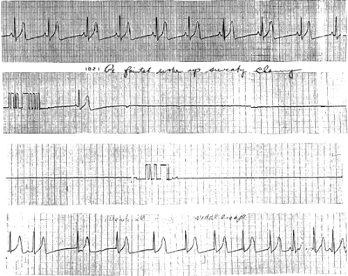 Sinus Node Function | Thoracic Key