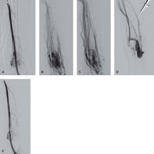 Vascular Tumors and Anomalies | Thoracic Key
