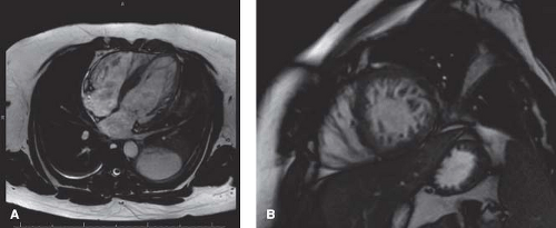 Left Ventricular Noncompaction Cardiomyopathy | Thoracic Key