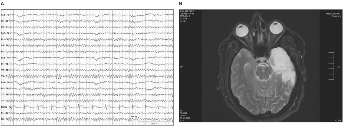 Normal Pediatric EEG: Neonates and Children | Thoracic Key