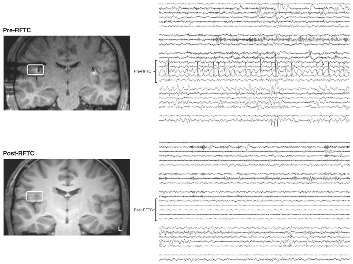 Normal Pediatric EEG: Neonates and Children | Thoracic Key