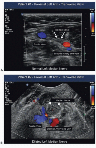 Upper Extremity Venous Thrombosis | Thoracic Key