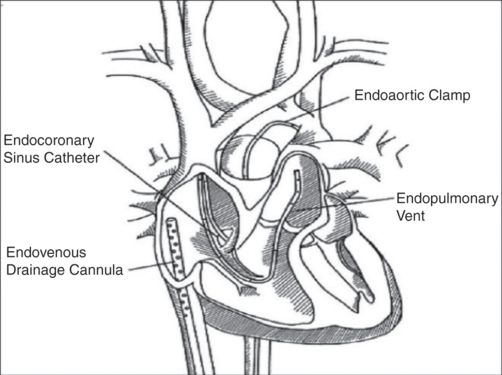 Myocardial protection and cardioplegia | Thoracic Key