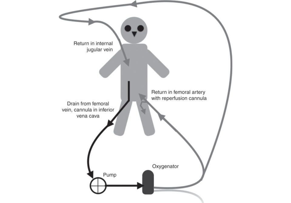 The ECMO circuit | Thoracic Key
