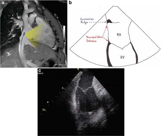 The Use of Intracardiac Echocardiography (ICE) to Guide LAA Closure ...