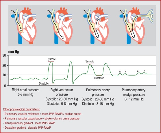 pulmonary-hypertension-due-to-left-heart-disease-thoracic-key