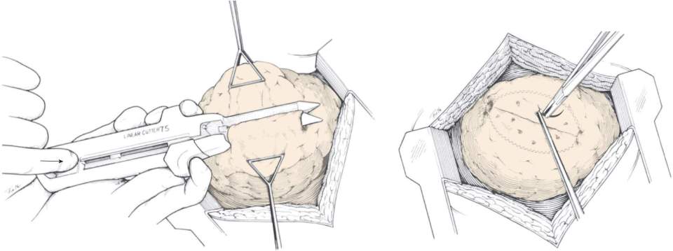 Lung, Trachea, and Esophagus | Thoracic Key